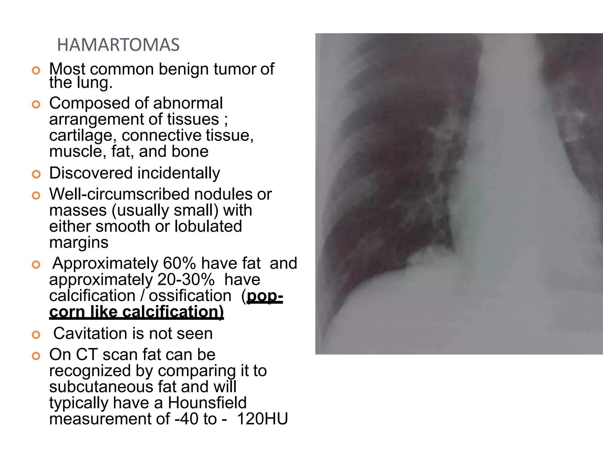 BENIGN AND MALIGNANT LUNG NEOPLASAM MASSES | PPTX