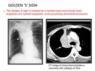 BENIGN AND MALIGNANT LUNG NEOPLASAM MASSES | PPTX