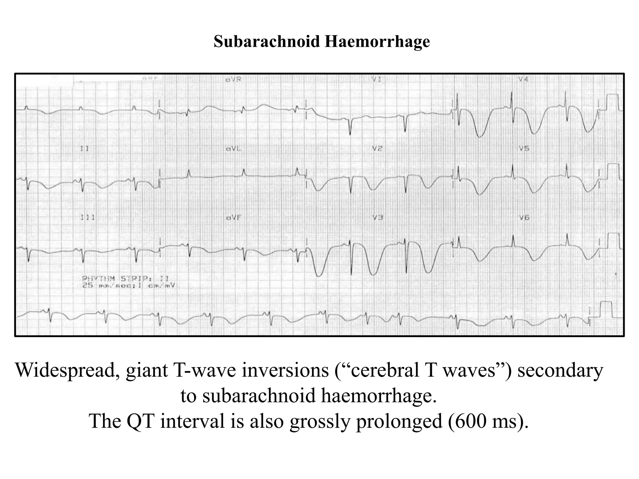 ECG abnormalities in drugs, temperature, electrolyte , metabolic and ...