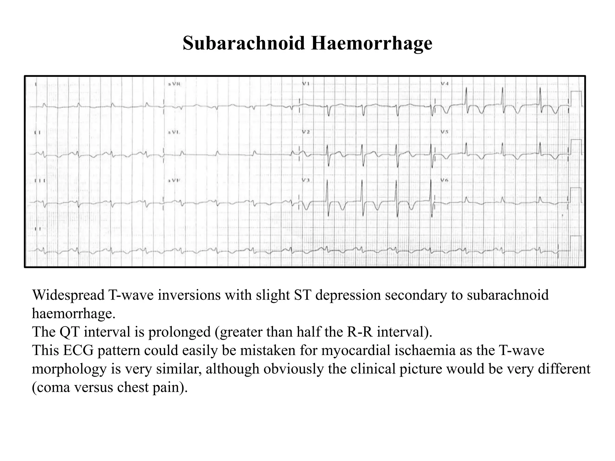 ECG abnormalities in drugs, temperature, electrolyte , metabolic and ...