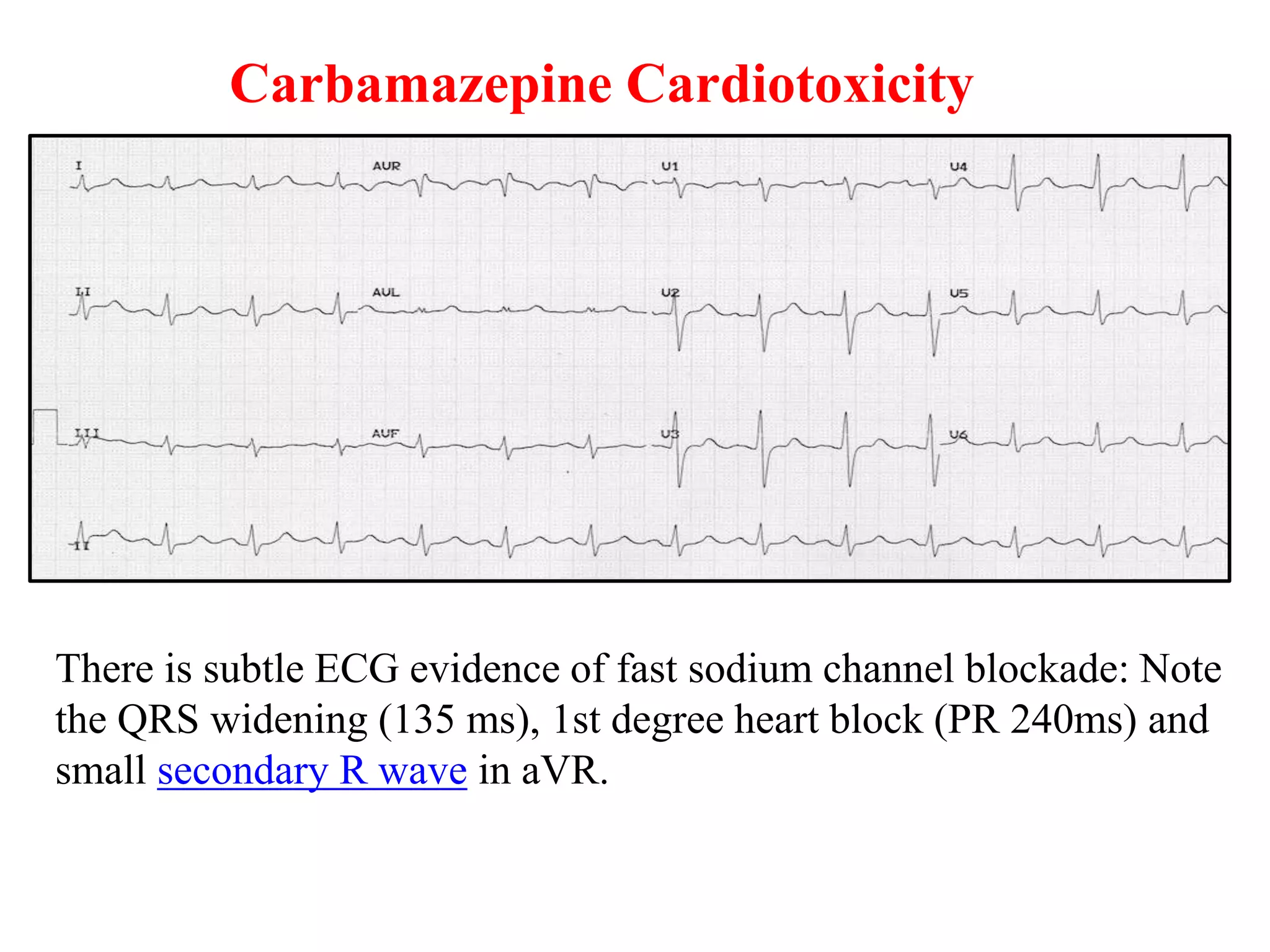 ECG abnormalities in drugs, temperature, electrolyte , metabolic and ...