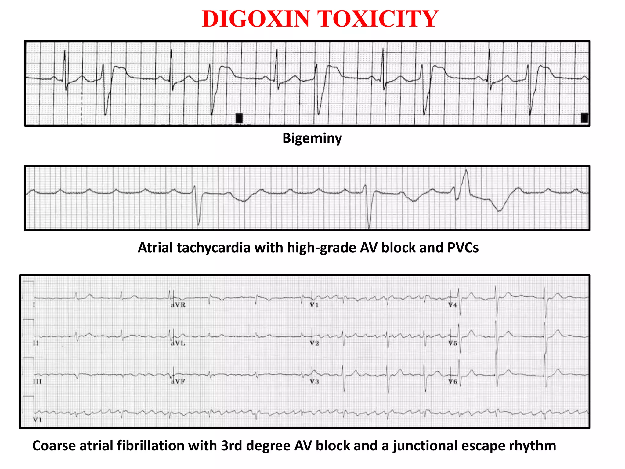 ECG abnormalities in drugs, temperature, electrolyte , metabolic and ...