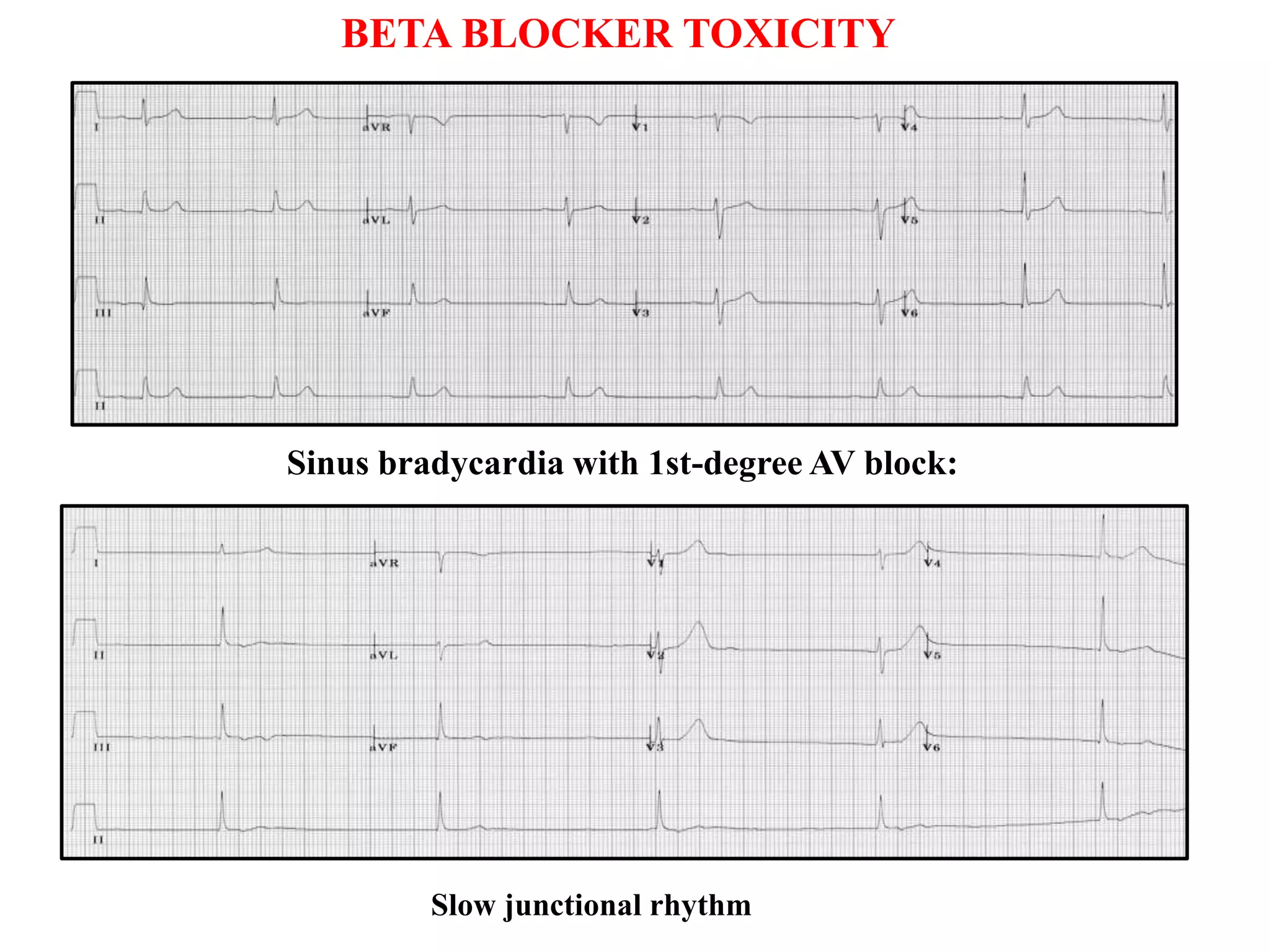 ECG abnormalities in drugs, temperature, electrolyte , metabolic and ...