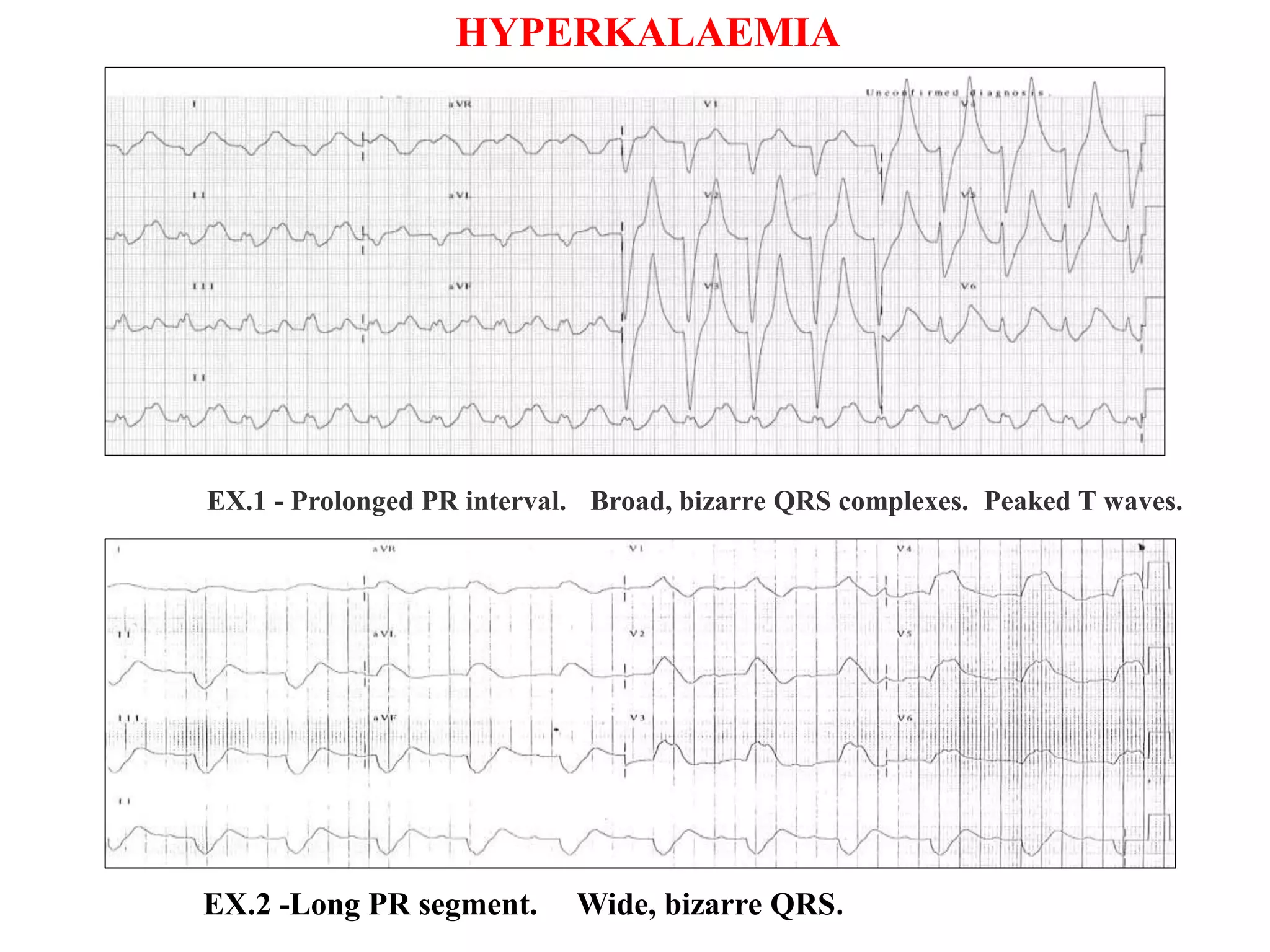 ECG abnormalities in drugs, temperature, electrolyte , metabolic and ...