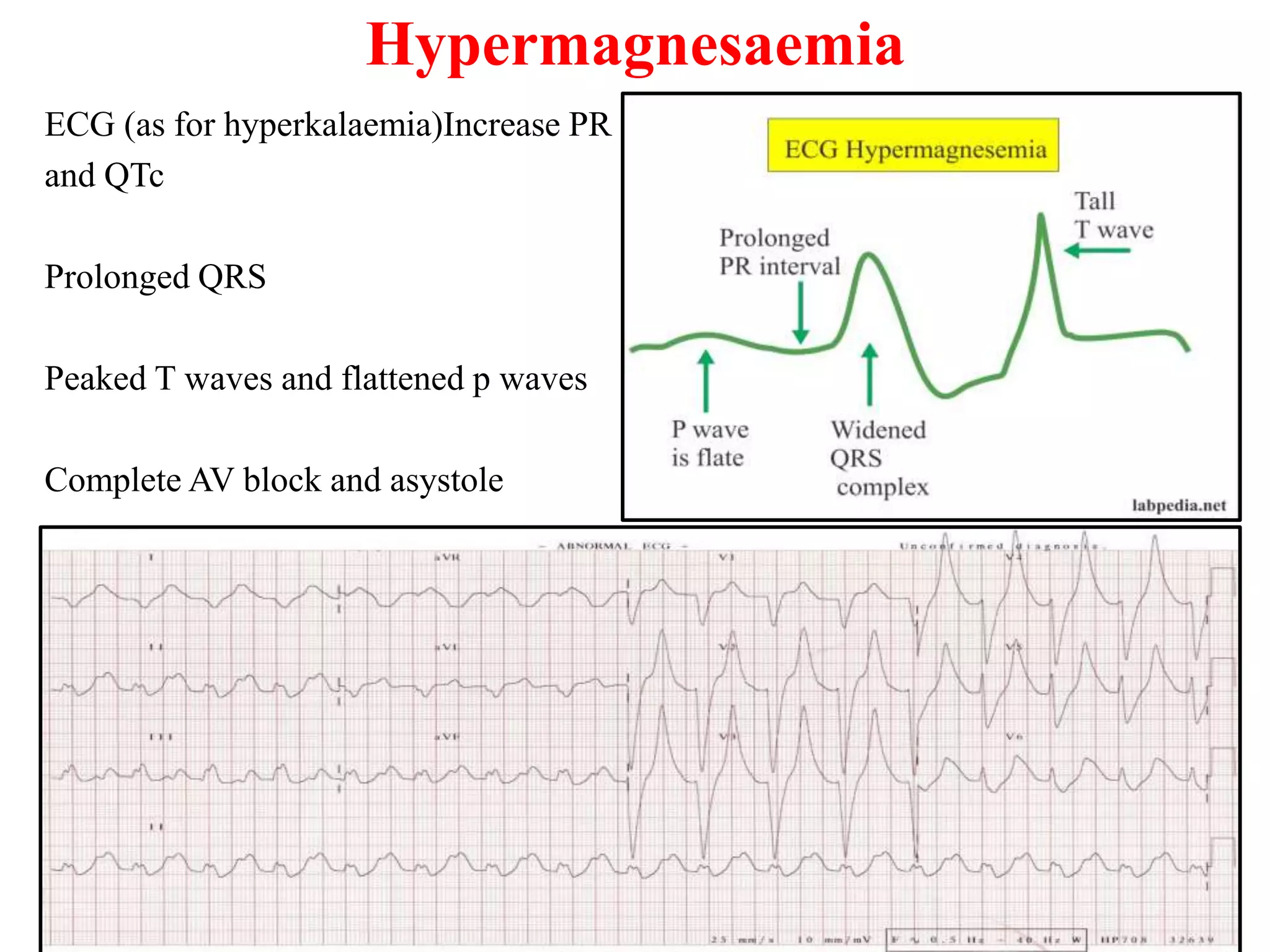 ECG abnormalities in drugs, temperature, electrolyte , metabolic and ...