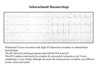 ECG abnormalities in drugs, temperature, electrolyte , metabolic and ...