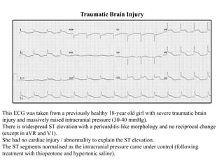 ECG abnormalities in drugs, temperature, electrolyte , metabolic and ...