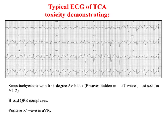 ECG abnormalities in drugs, temperature, electrolyte , metabolic and ...