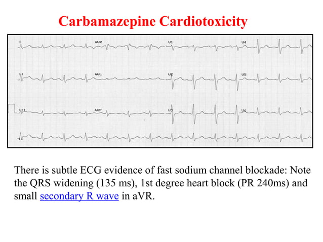 ECG abnormalities in drugs, temperature, electrolyte , metabolic and ...