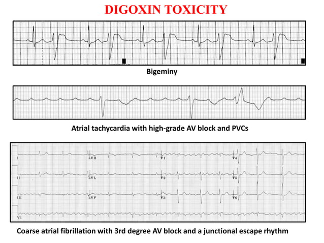 ECG abnormalities in drugs, temperature, electrolyte , metabolic and ...