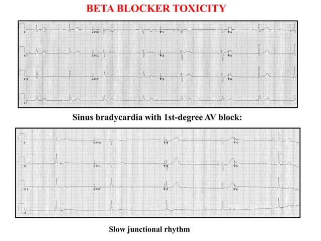 ECG abnormalities in drugs, temperature, electrolyte , metabolic and ...
