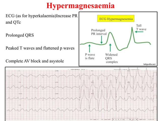 ECG abnormalities in drugs, temperature, electrolyte , metabolic and ...