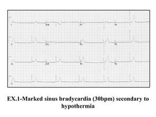 ECG abnormalities in drugs, temperature, electrolyte , metabolic and ...