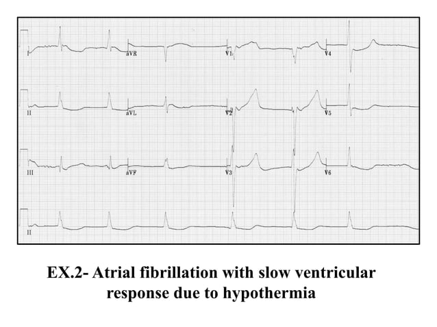 ECG abnormalities in drugs, temperature, electrolyte , metabolic and ...
