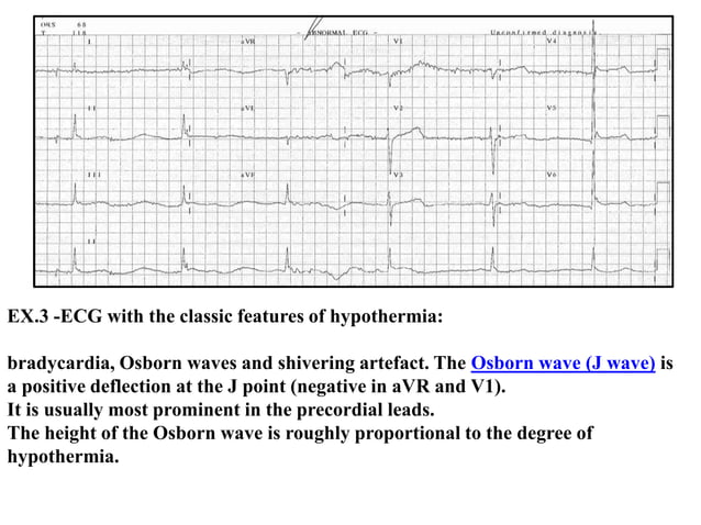 ECG abnormalities in drugs, temperature, electrolyte , metabolic and ...