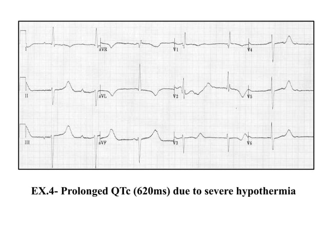 ECG abnormalities in drugs, temperature, electrolyte , metabolic and ...