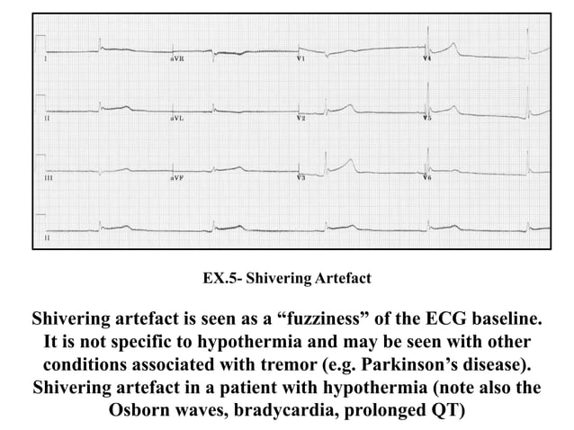 ECG abnormalities in drugs, temperature, electrolyte , metabolic and ...