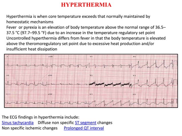 ECG abnormalities in drugs, temperature, electrolyte , metabolic and ...