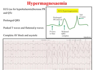 Hypermagnesemia Ecg