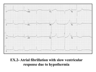Atrial Fibrillation With Slow Ventricular Response