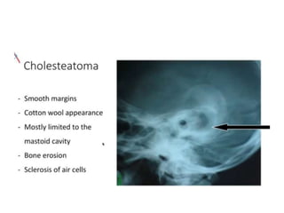 Mastoid Air Cells X Ray