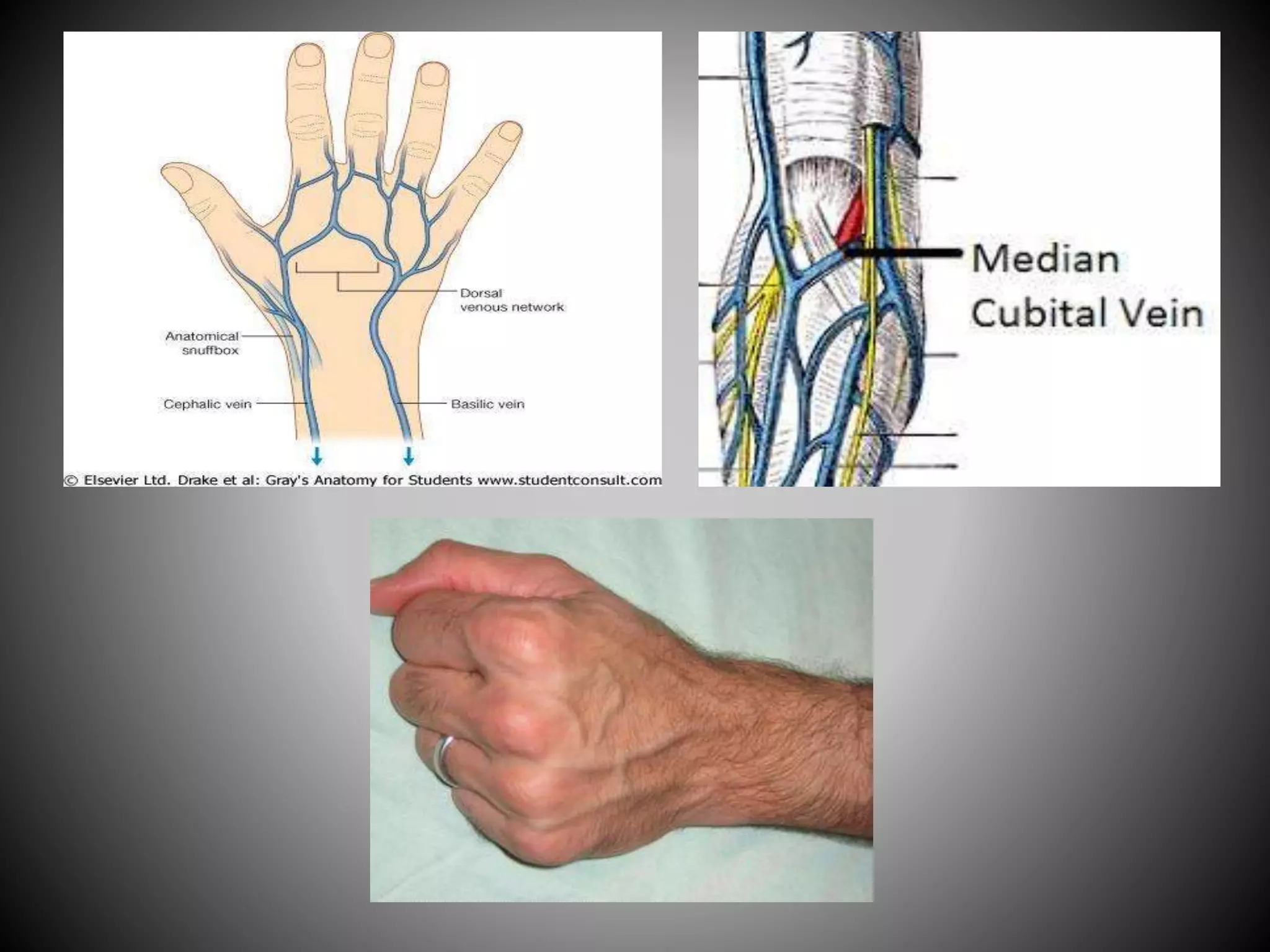 cannulation and introduction, sizes and site of cannula | PPTX