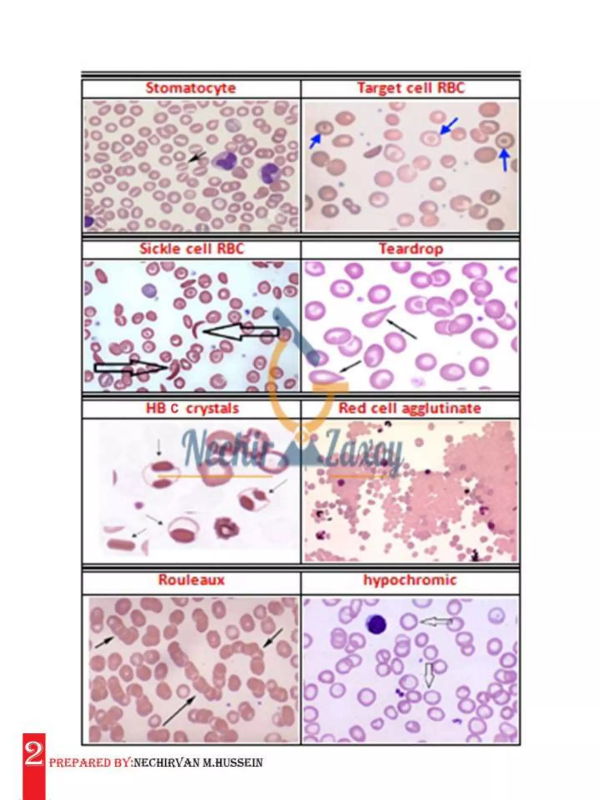 abnormal rbc morphology | PPTX