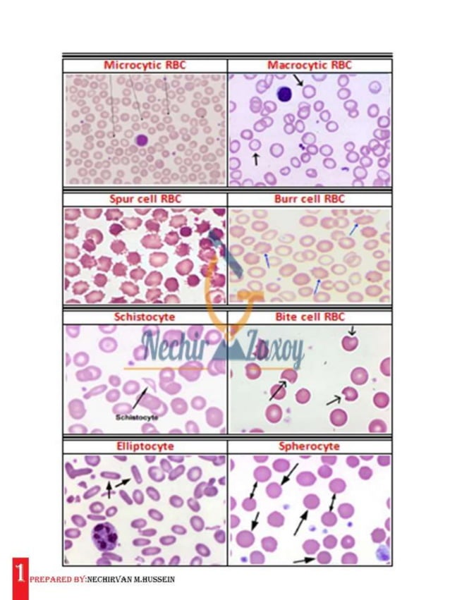 abnormal rbc morphology | PPTX