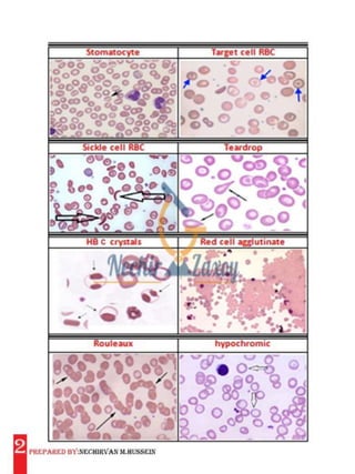 abnormal rbc morphology | PPTX