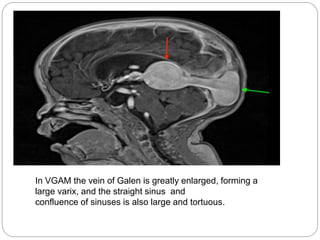 Stroke in children and young adult | PPTX