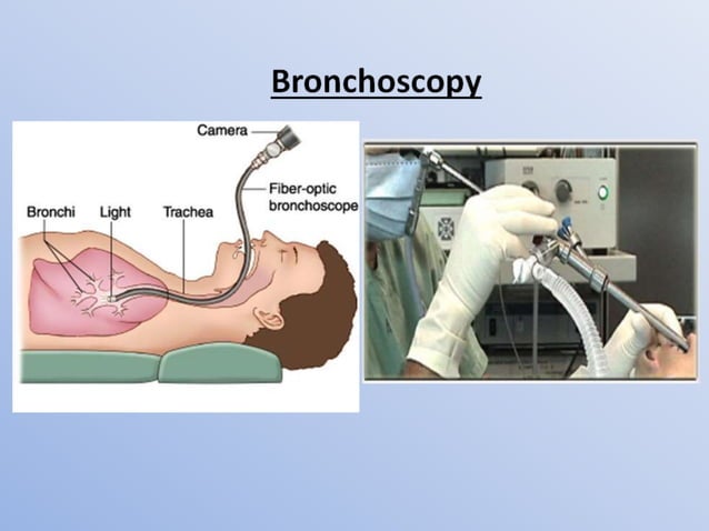 Bronchoscopy | PPT