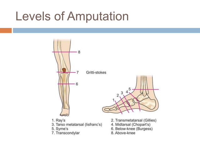 Amputation | PPTX | Death, Injury, or Military Conflict | Sensitive Topics
