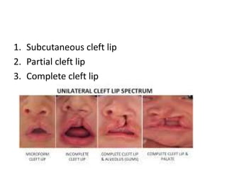 Unilateral cleft lip | PPTX