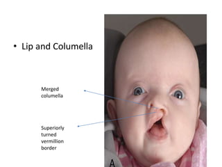 Unilateral cleft lip | PPTX