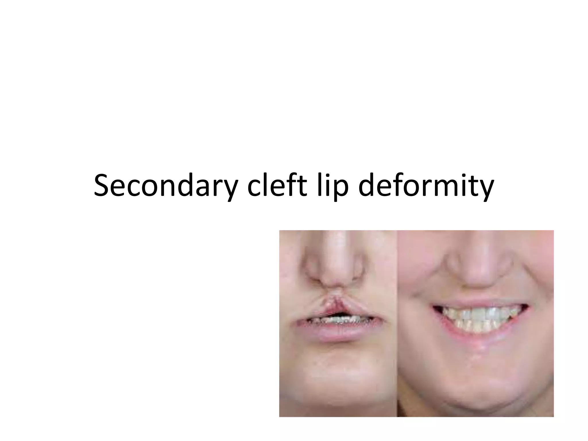 Secondary cleft lip deformities | PPTX