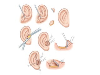 Microtia- diagnosis and management | PPTX