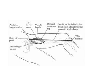 Gracilis and Latissimus Dorsi flap | PPTX