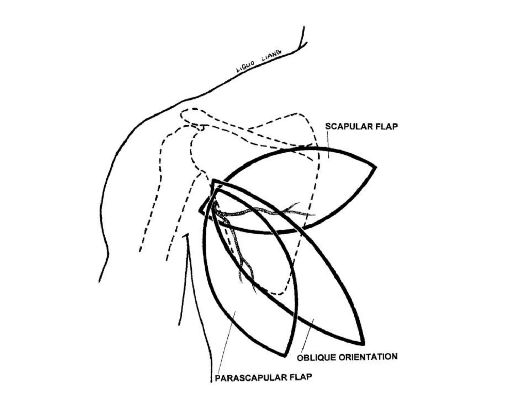 Parascapular and free fibula flaps | PPTX