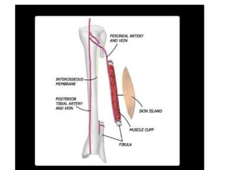 Parascapular and free fibula flaps | PPTX