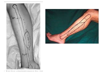 Parascapular and free fibula flaps | PPTX