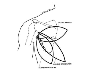 Parascapular and free fibula flaps | PPTX