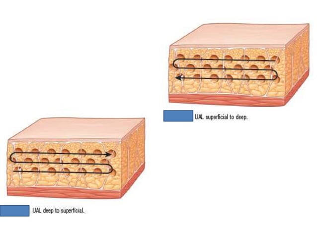 Liposuction- techniques and indications | PPTX