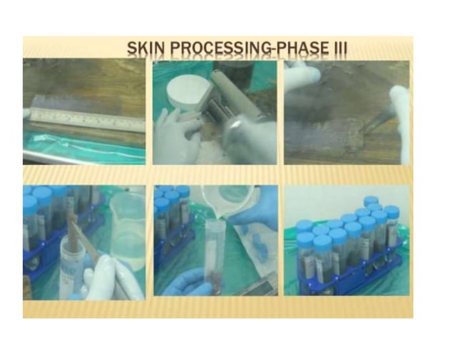Skin donation, skin banking, skin culture | PPT
