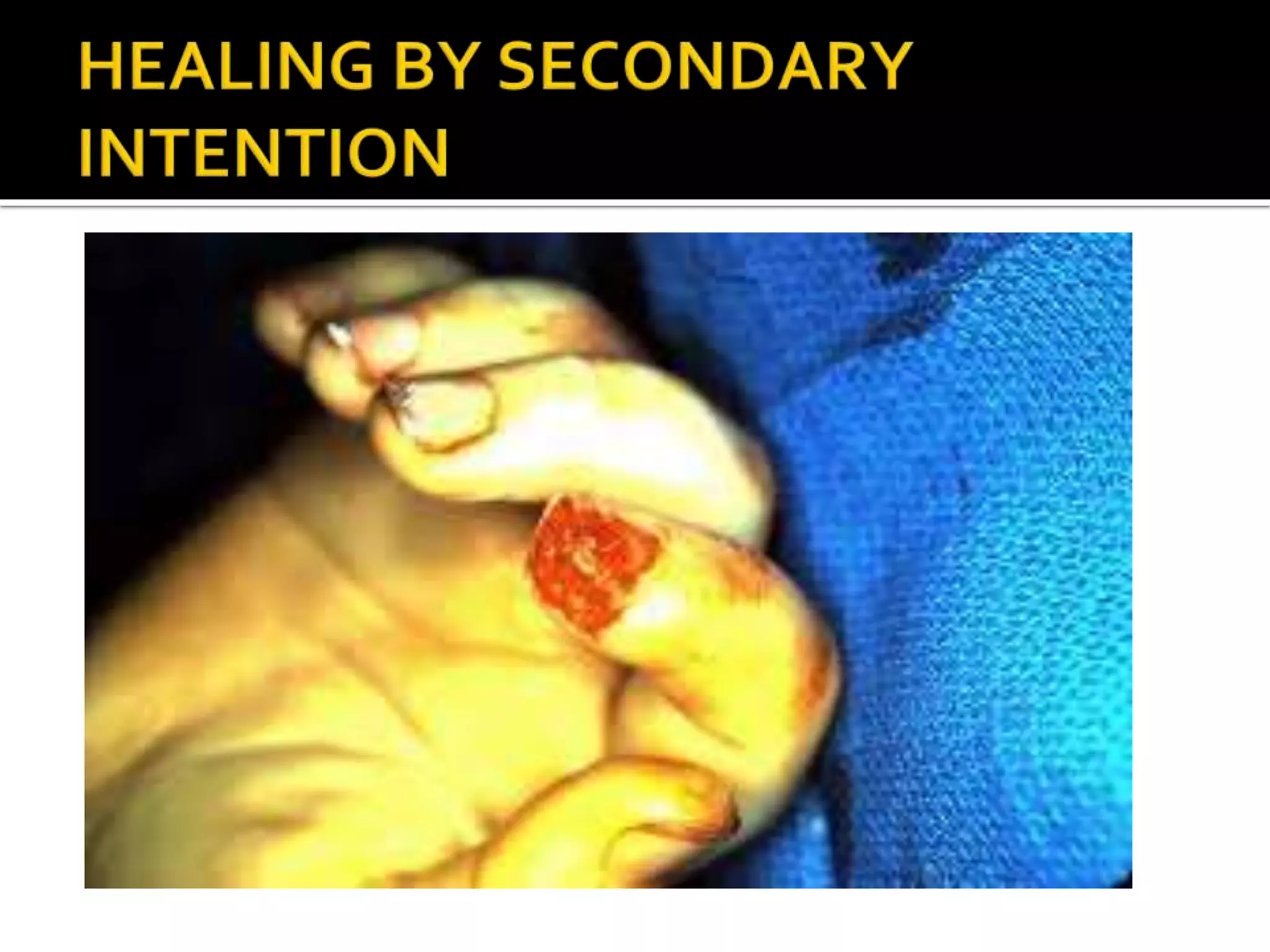 Soft tissue reconstruction of the upper extremity.pptx