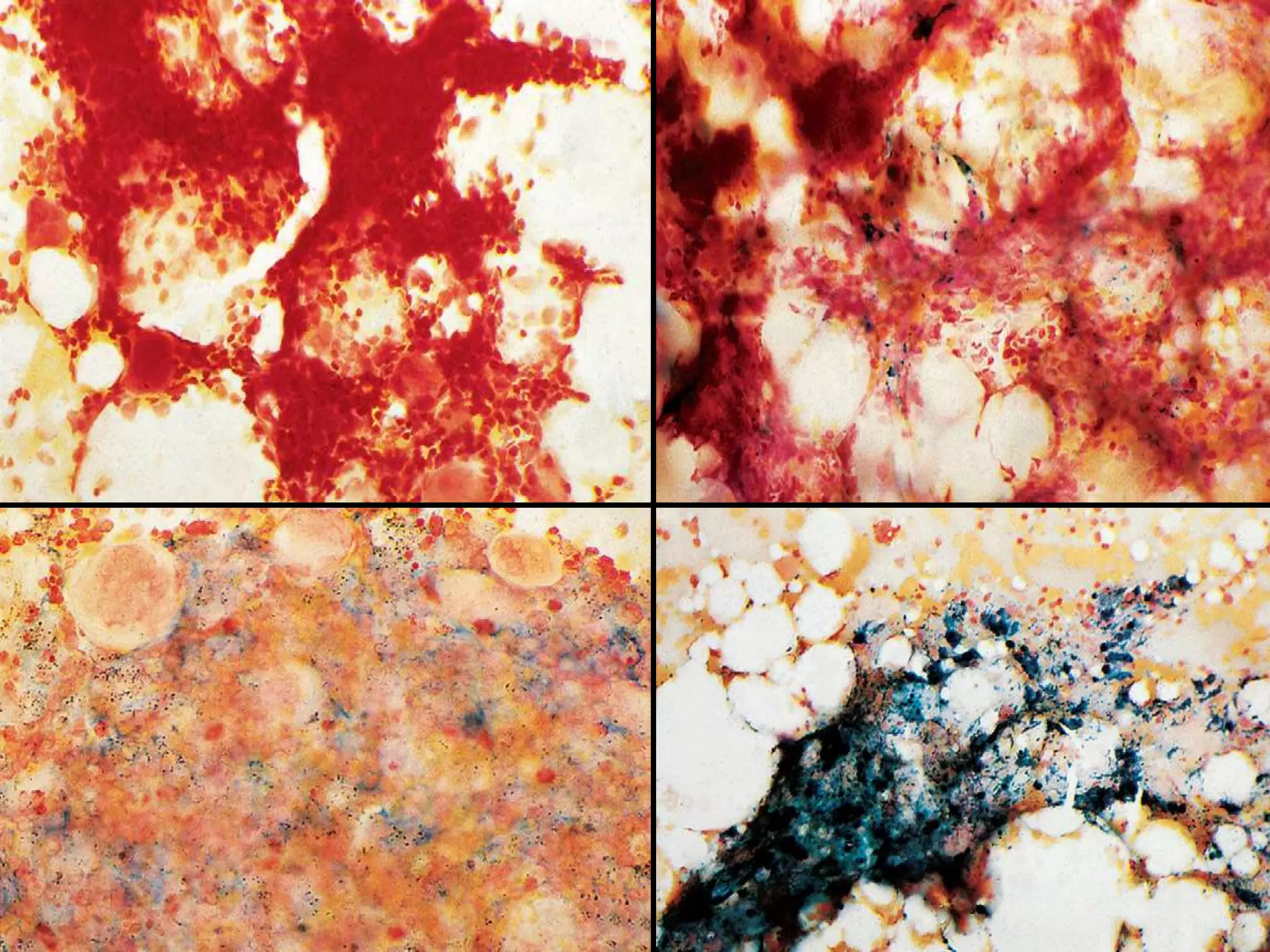 Special stains in Bone marrow examination | PPTX