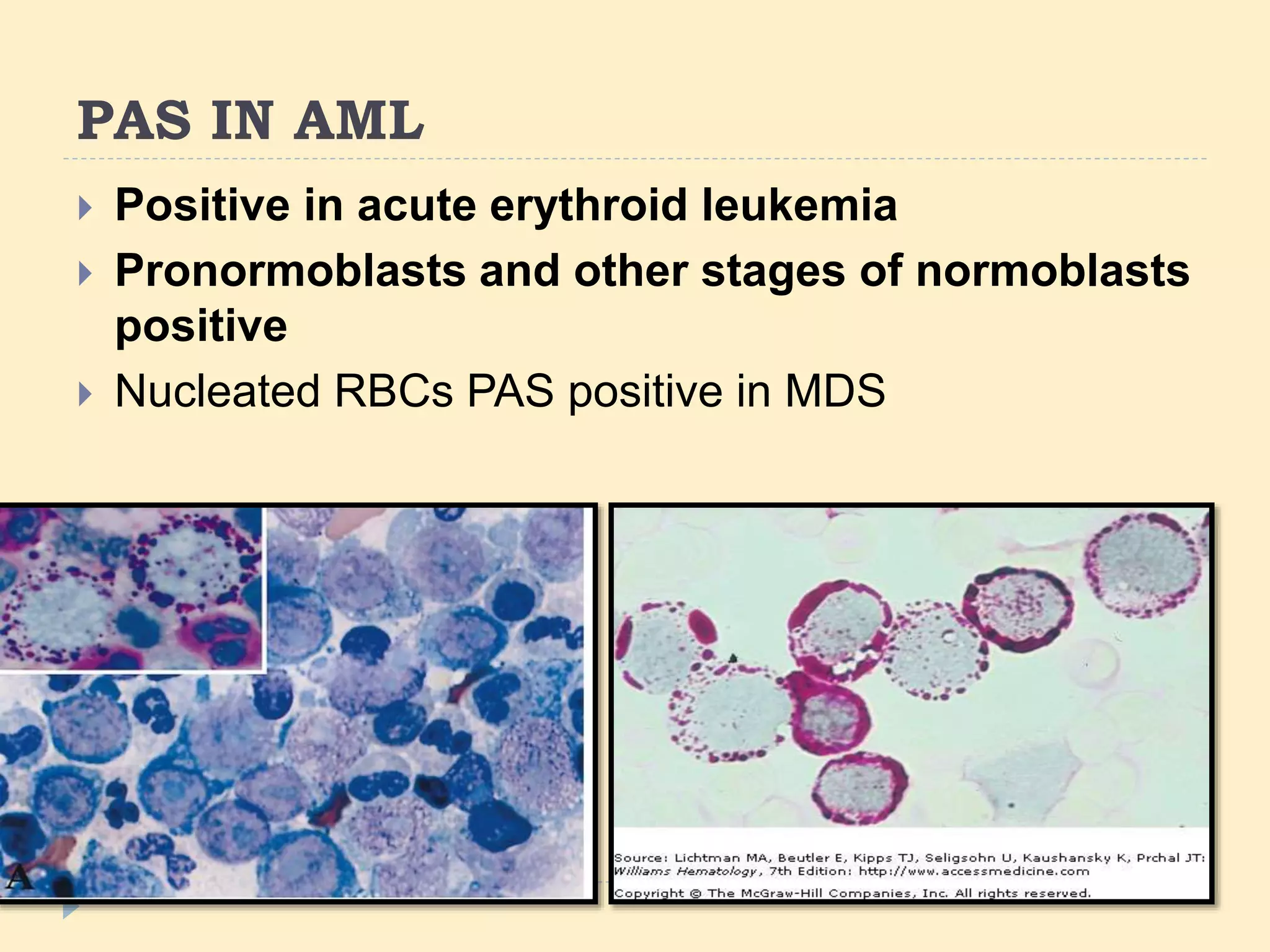 Special stains in Bone marrow examination | PPTX