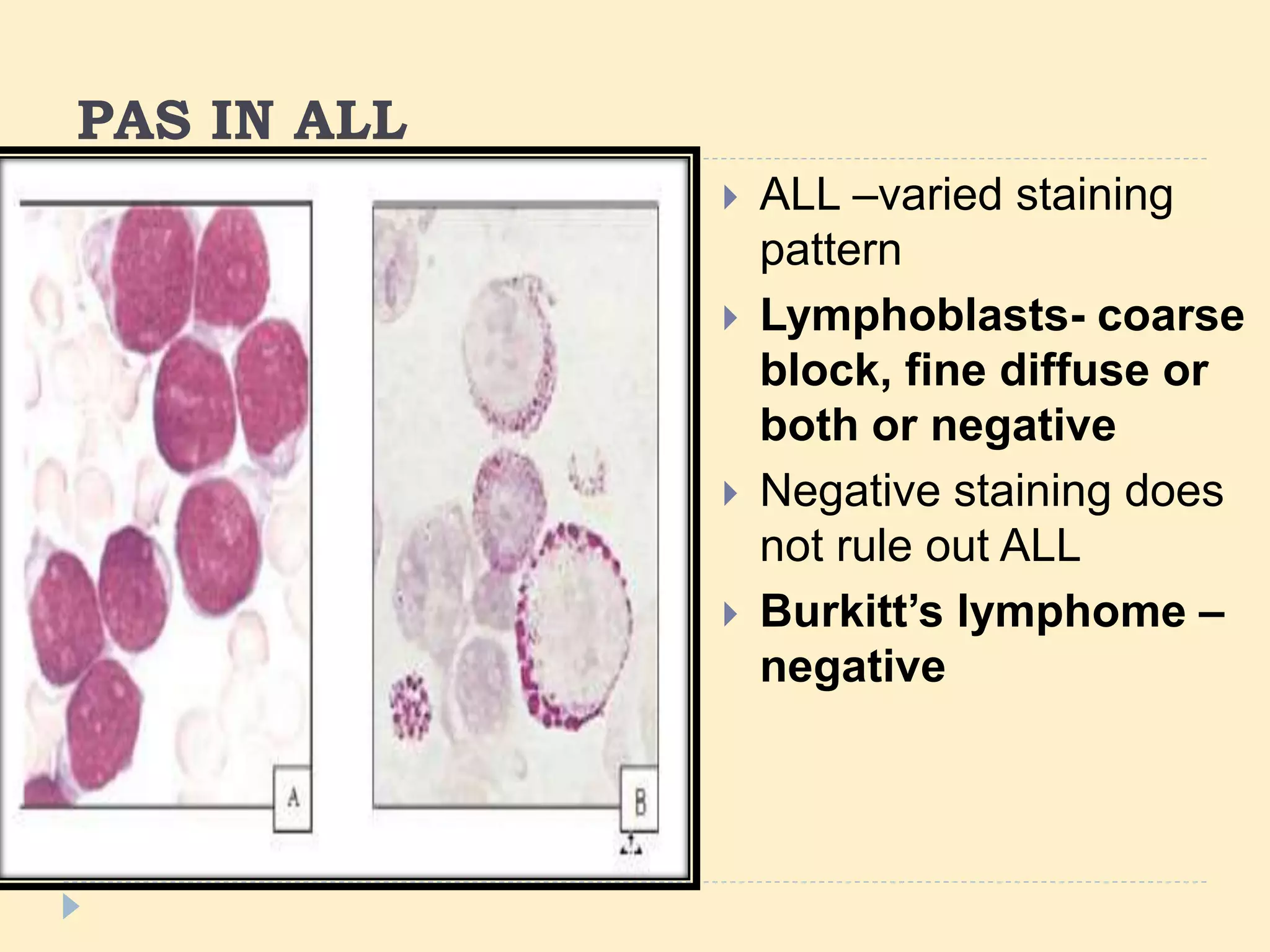 Special stains in Bone marrow examination | PPTX
