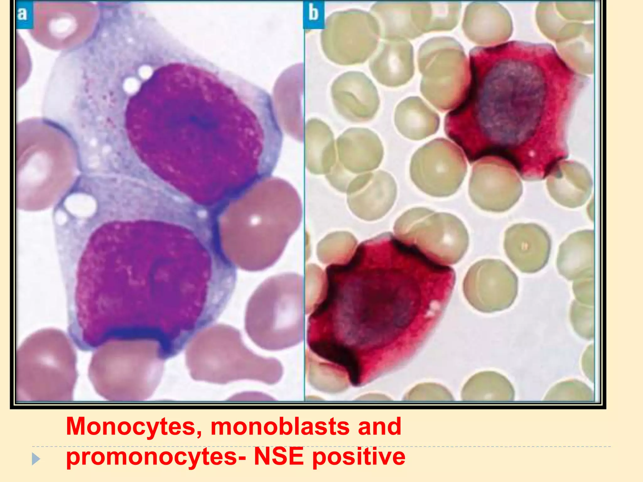 Special stains in Bone marrow examination | PPTX