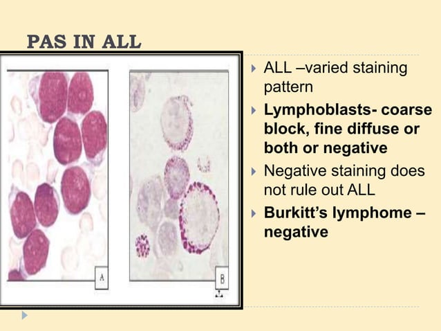 Special stains in Bone marrow examination | PPTX | Blood Disorders | Diseases and Conditions