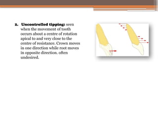 Mechanics of tooth movement, tooth movement in oral cavity | PPTX